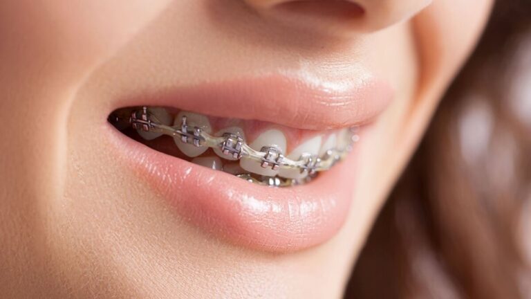 How Power Chain Braces Work & All Your Questions Answered - TheWellthieone