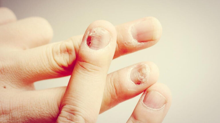 Nail Psoriasis vs. Fungus: What’s the Difference? - TheWellthieone