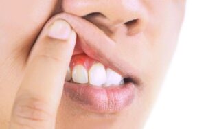 Gum Abscess Stages-A Dental Hygienist’s Guide to Gum Abscesses ...
